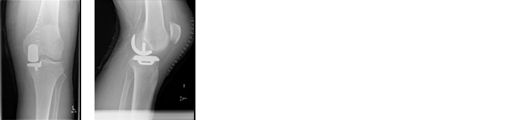 Partial Knee Replacement – Midland Knee Clinic